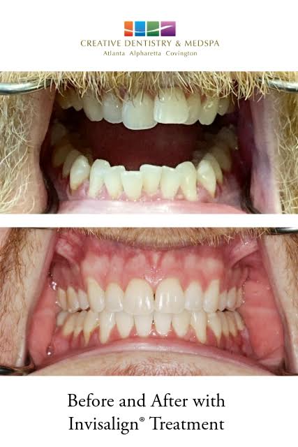 Dunwoody Invisalign Treatment | Dentist Atlanta, Ga