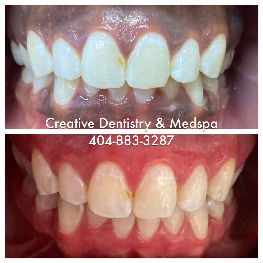 Gum Bleaching in Sandy Springs GA Gum Depigmentation Experts