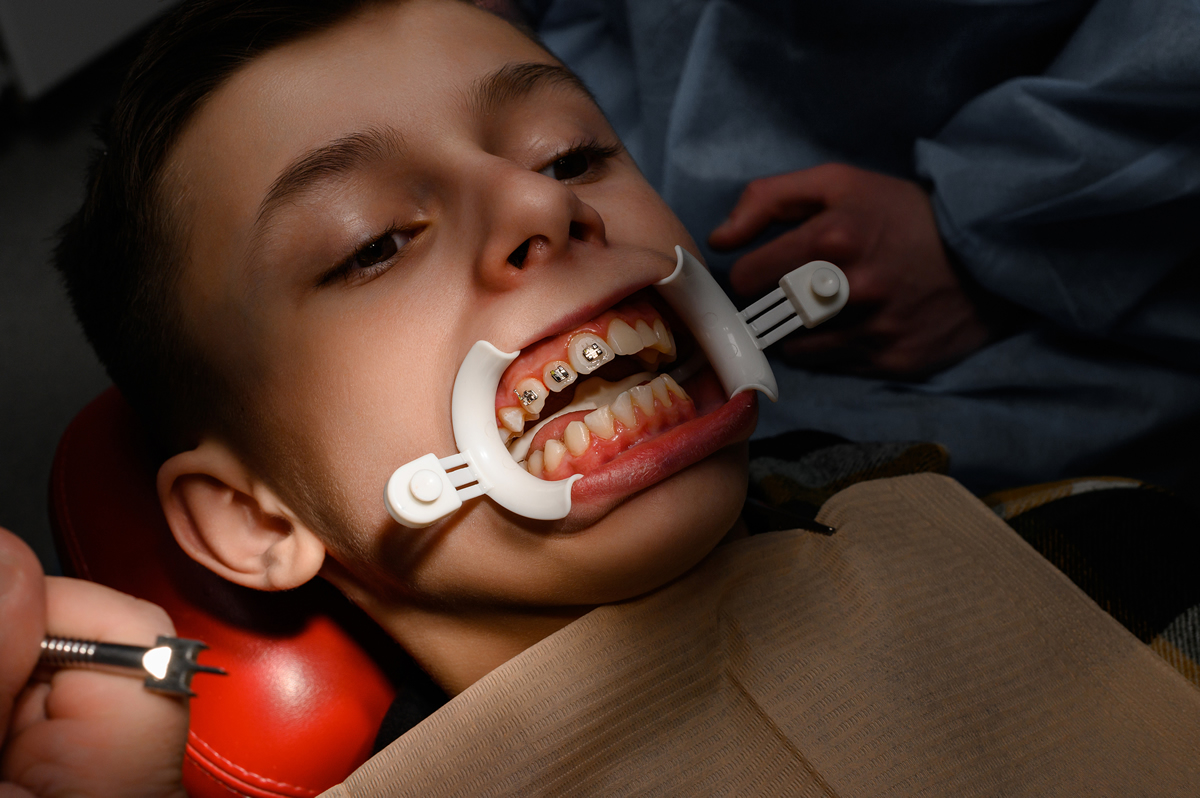 Crossbites, Deep Bites: Causes, Symptoms, Treatment in ATL