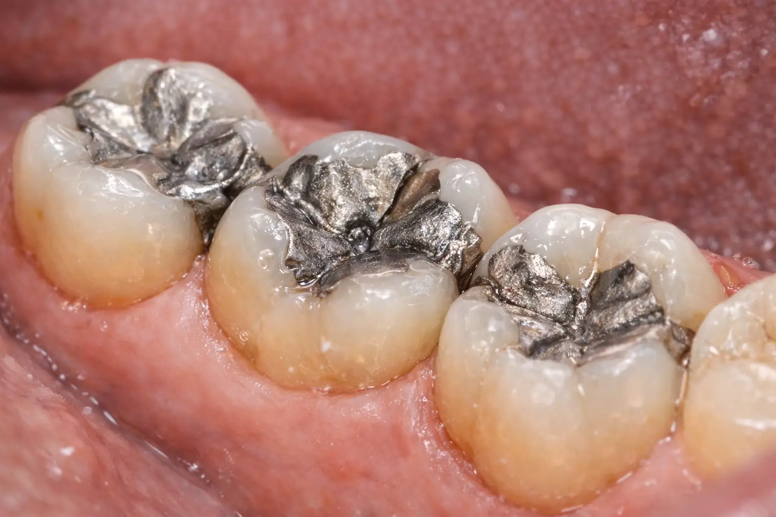 Old Amalgam Silver Fillings: When to Replace Them
